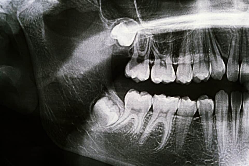 Wisdom Teeth - Anthem Oral Surgery & Implant Center
