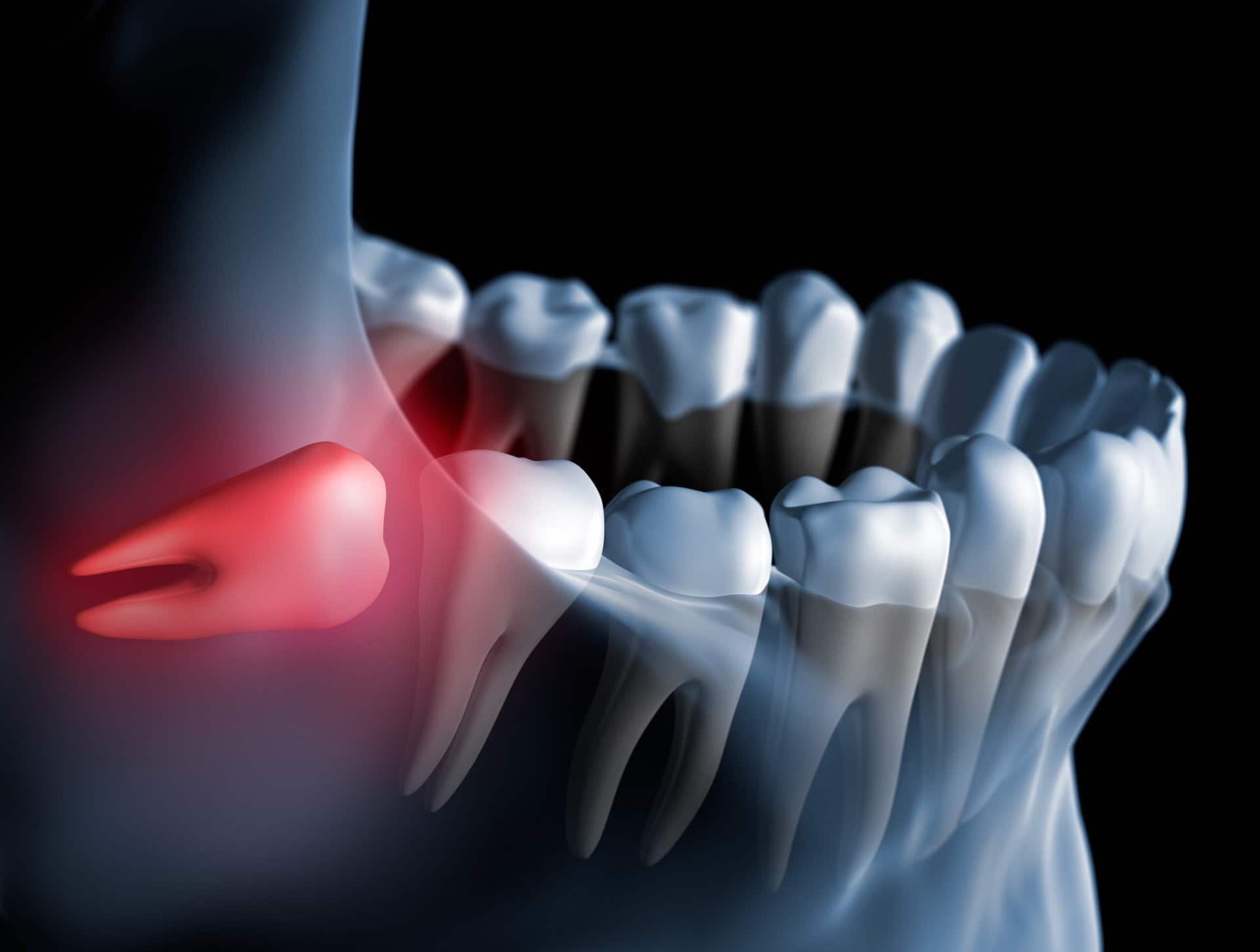 Wisdom Teeth Anthem Oral Surgery And Implant Center