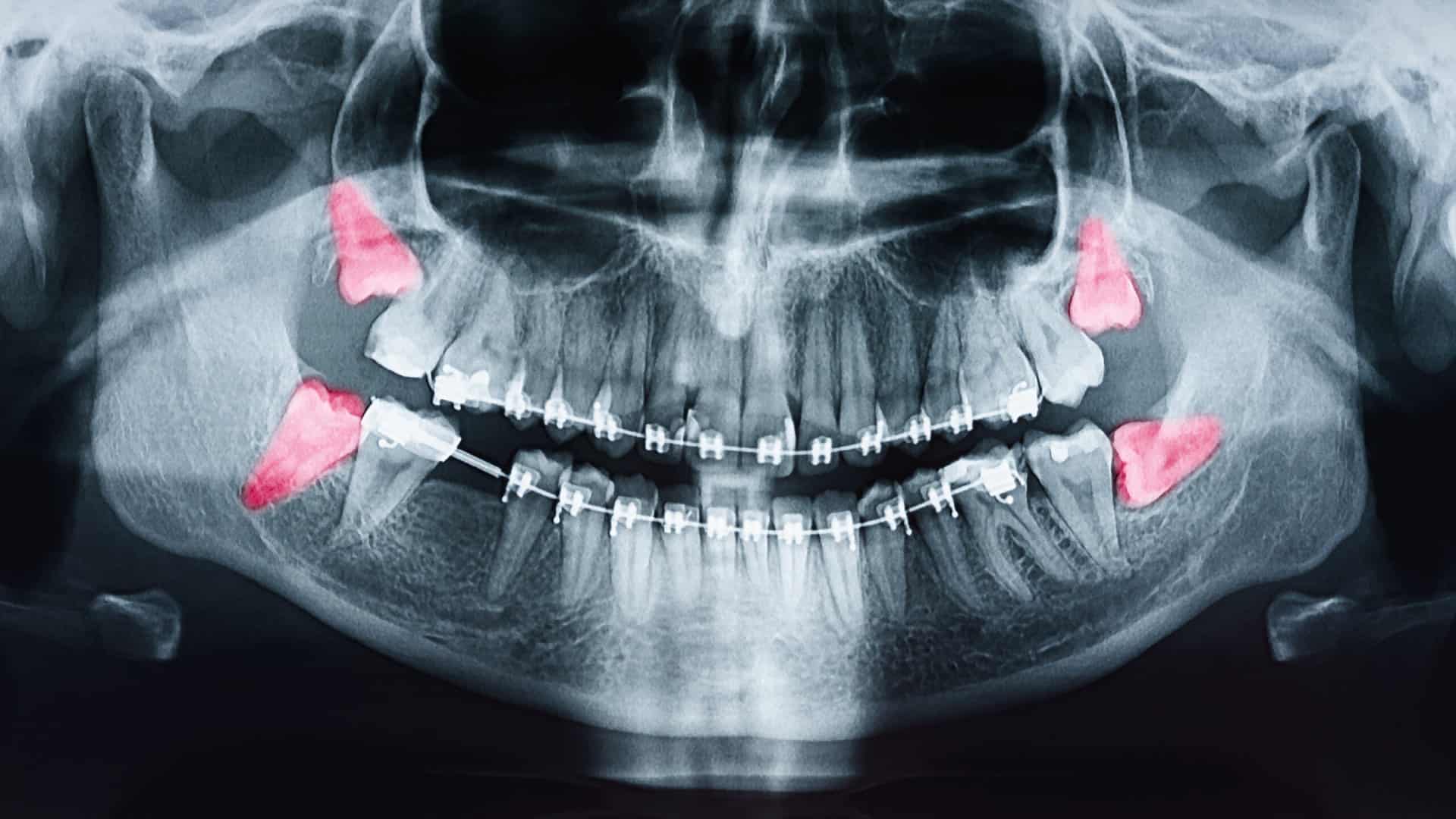 Impacted Wisdom Teeth Anthem Oral Surgery And Implant Center